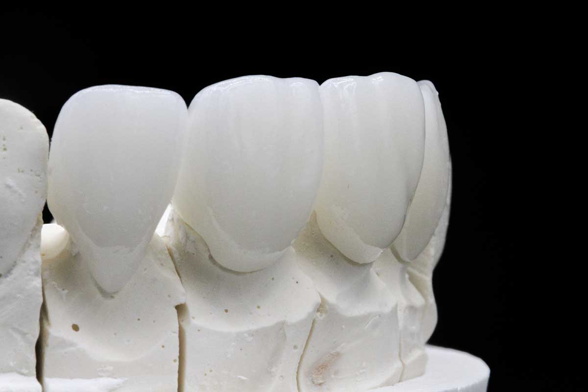Couronne Full Emax 9 No Retouch - Laboratoire 3D Dental Impression