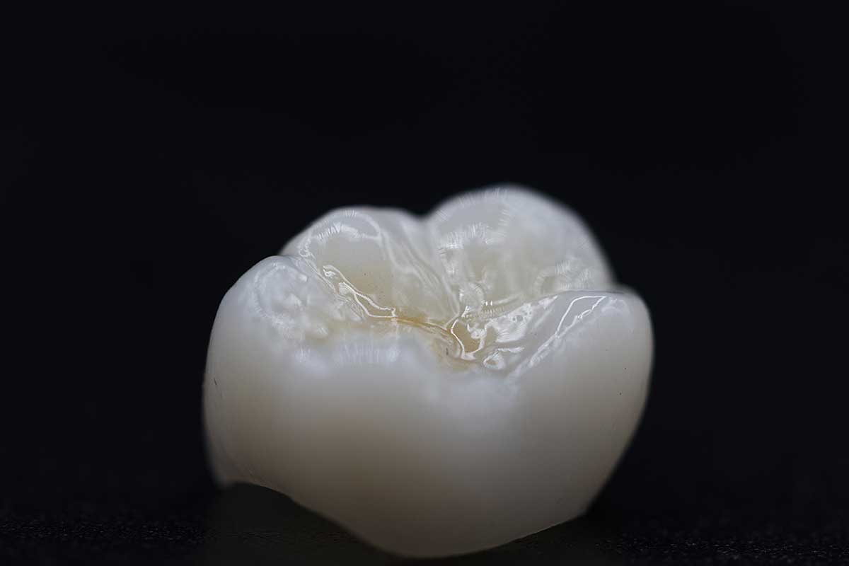 Couronne Full Emax 9 No Retouch - Laboratoire 3D Dental Impression