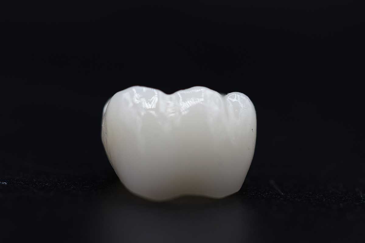 Couronne Full Emax 9 No Retouch - Laboratoire 3D Dental Impression