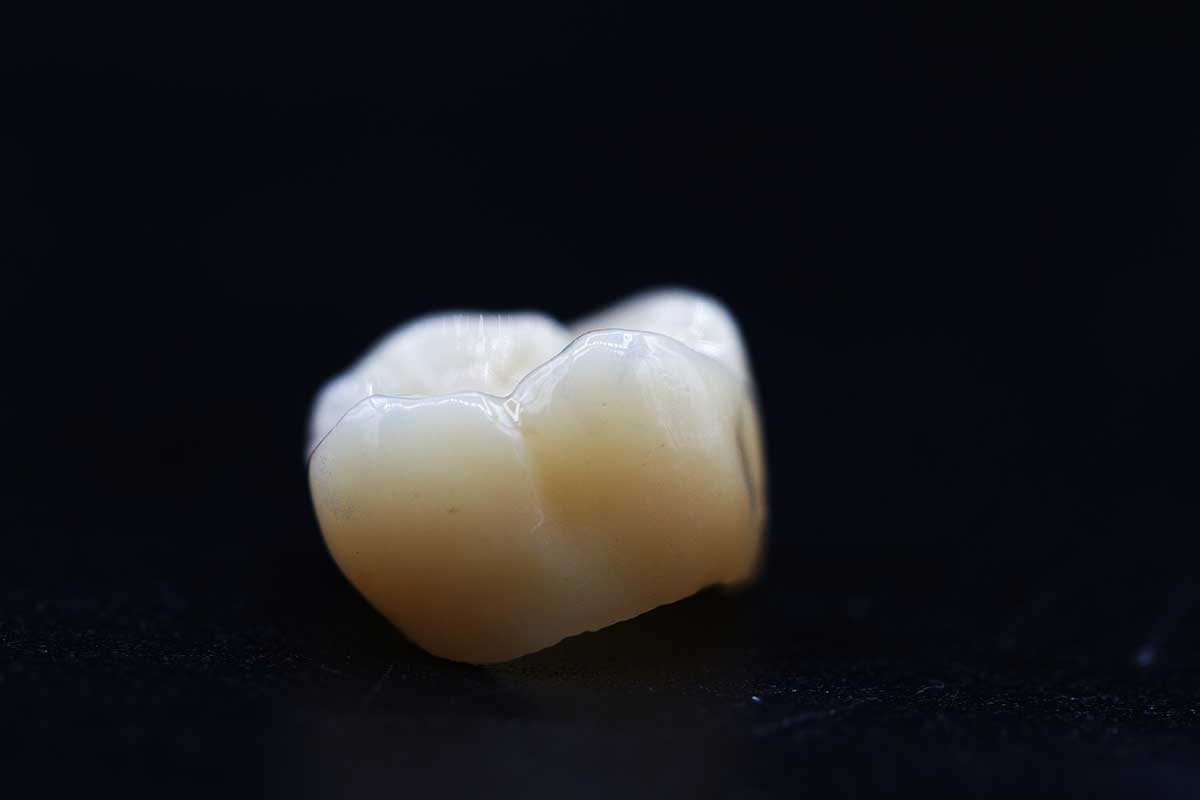 Couronne Full Zircone 9 no retouch - Laboratoire 3D Dental Impression