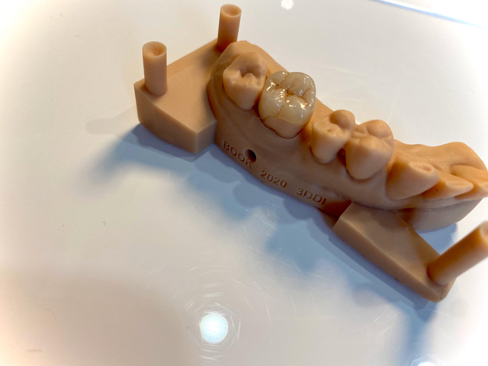 Onlay Emax - Laboratoire 3D Dental Impression