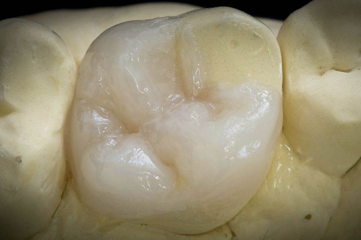 Onlay Composite - Laboratoire 3D Dental Impression