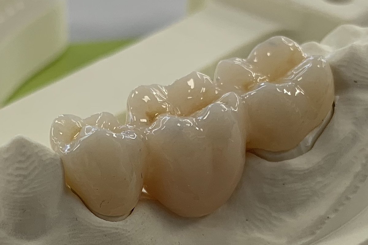 Couronne Full Zircone 9 no retouch - Laboratoire 3D Dental Impression