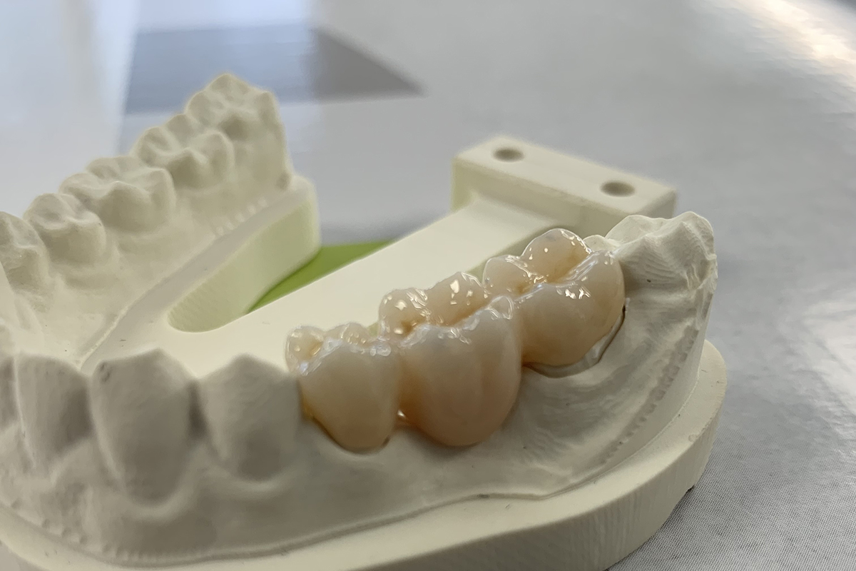 Couronne Full Zircone 9 no retouch - Laboratoire 3D Dental Impression