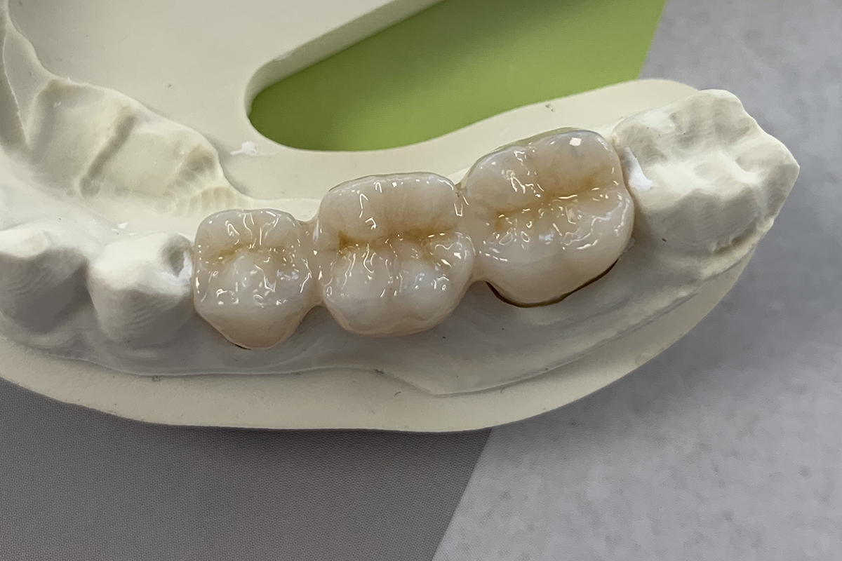 Couronne Full Zircone 9 no retouch - Laboratoire 3D Dental Impression