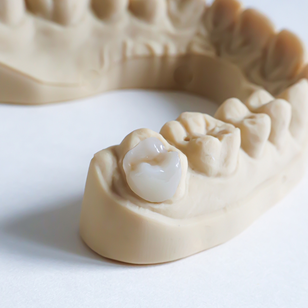 Onlay Emax - Laboratoire 3D Dental Impression