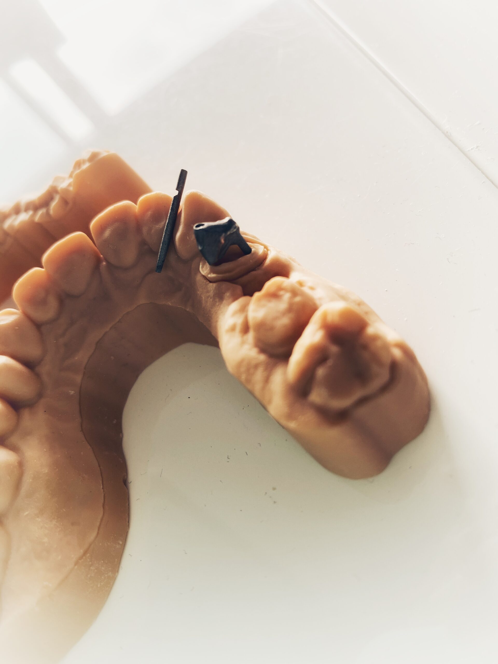 Inlay Core Chrome Colbalt - Laboratoire 3D Dental Impression