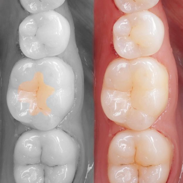 Onlay Emax - Laboratoire 3D Dental Impression