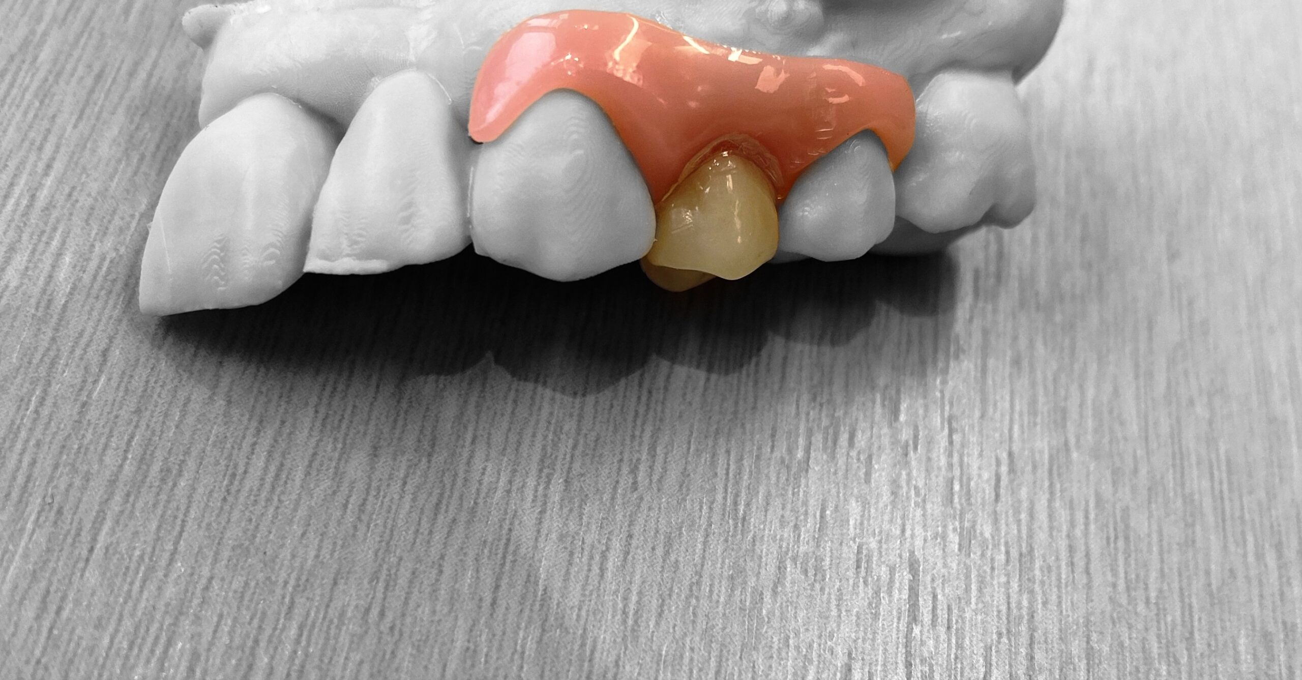 Appareil Résine Maxillaire/Mandibulaire - Laboratoire 3D Dental Impression