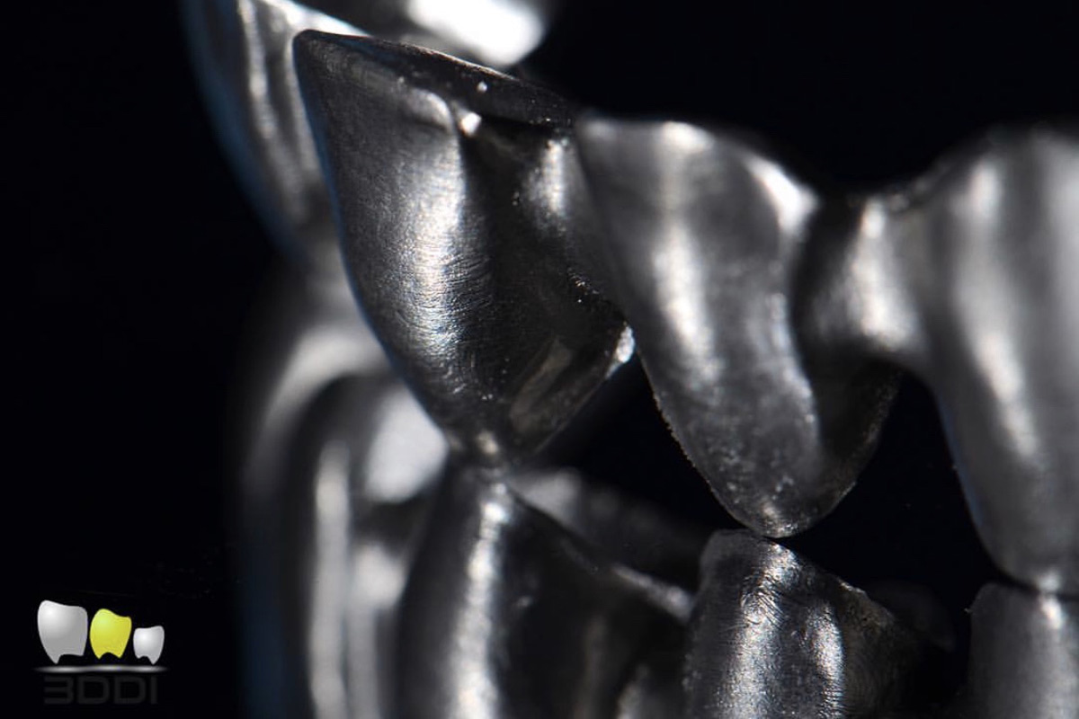 Couronne céramo-métallique - Laboratoire 3D Dental Impression